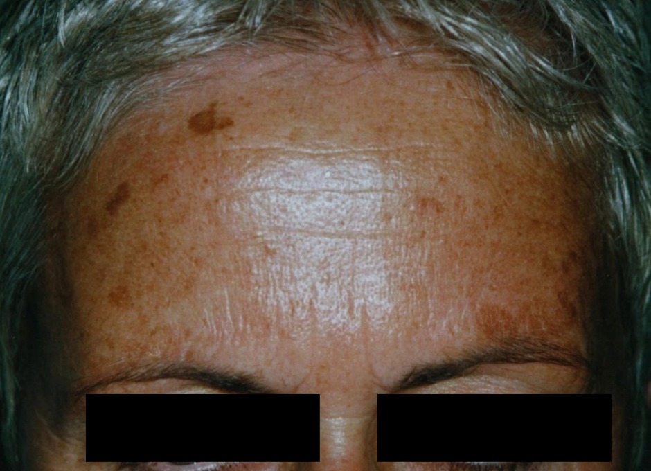 MeDioStar® Professional Diode Laser | Asclepion UK