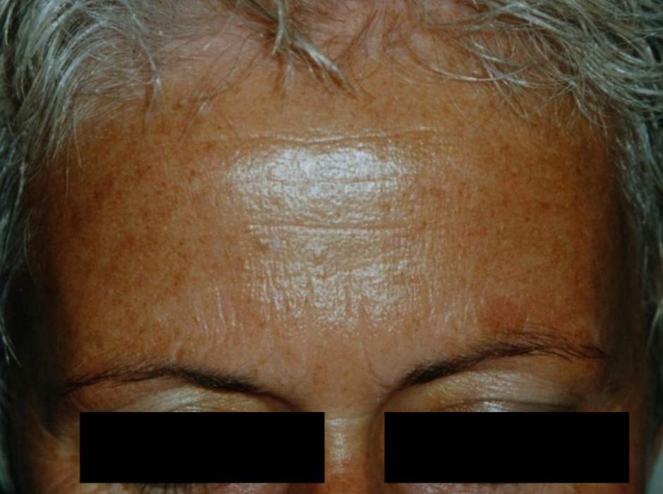 MeDioStar® Professional Diode Laser | Asclepion UK
