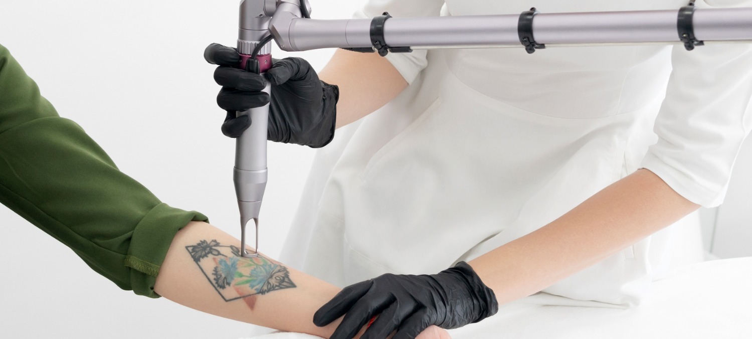 The Next Generation of Tattoo Removal | Asclepion UK
