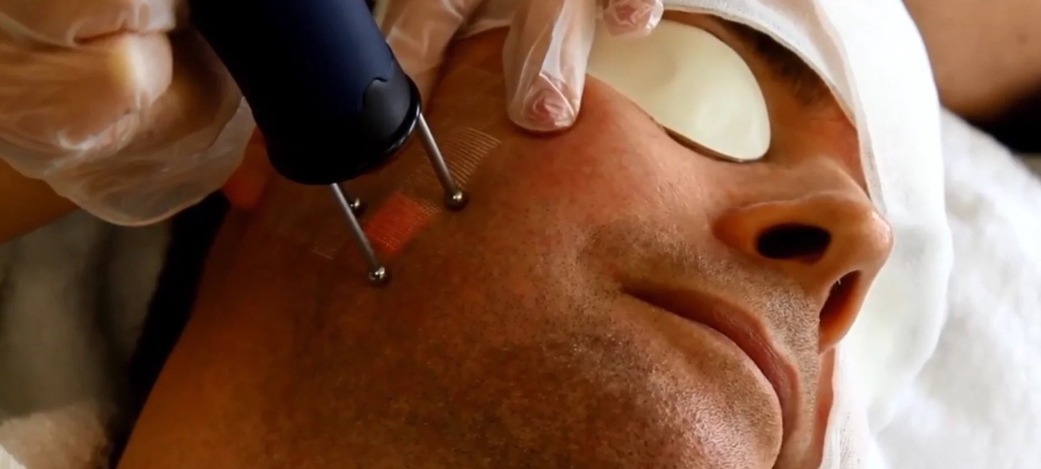 Laser Skin Resurfacing with Cool Laser | Asclepion UK