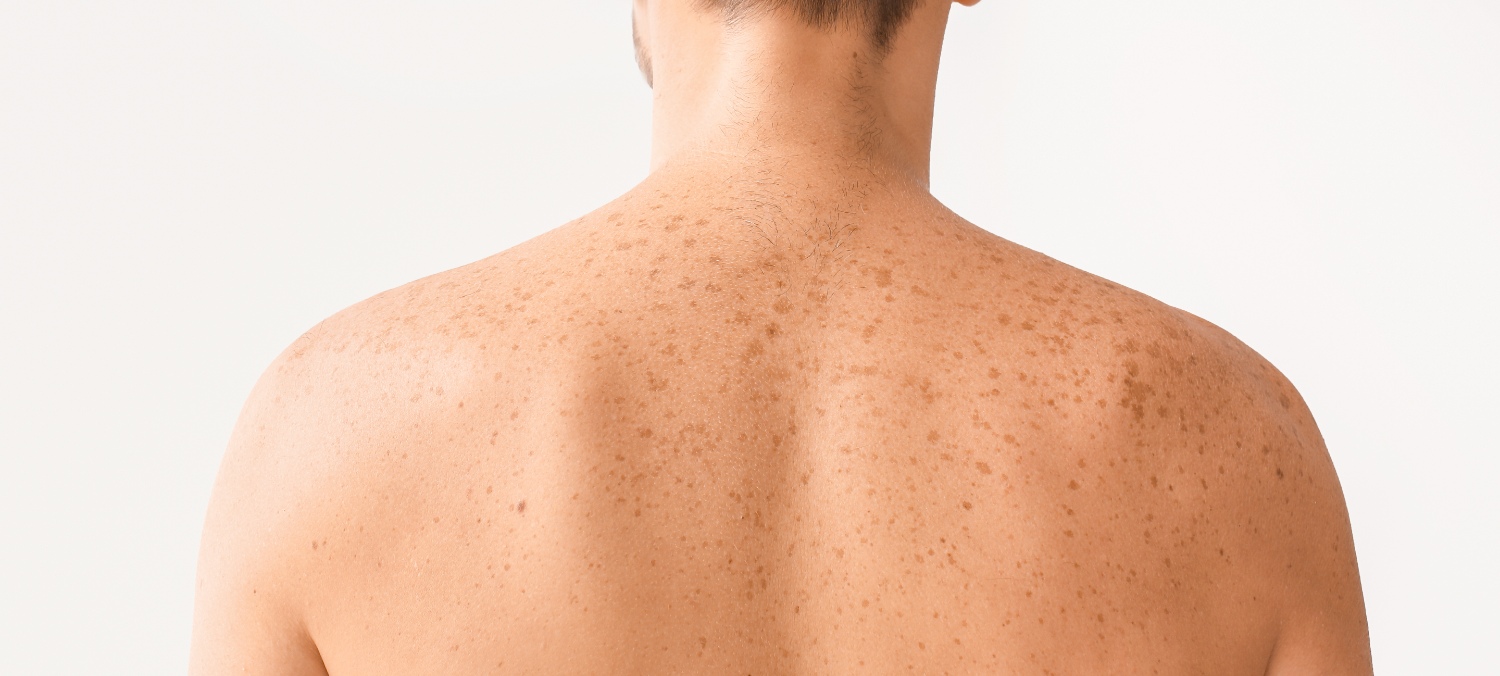 Pigmentation Laser Protocols | Melasma & PIH Treatment
